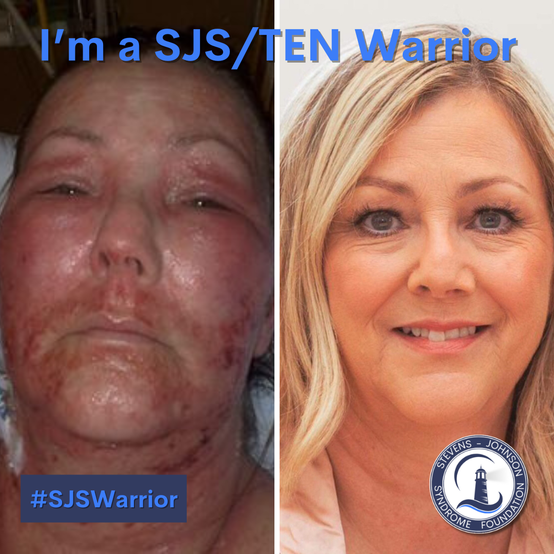 Meet Our SJS Warriors – Stevens-Johnson Syndrome Foundation